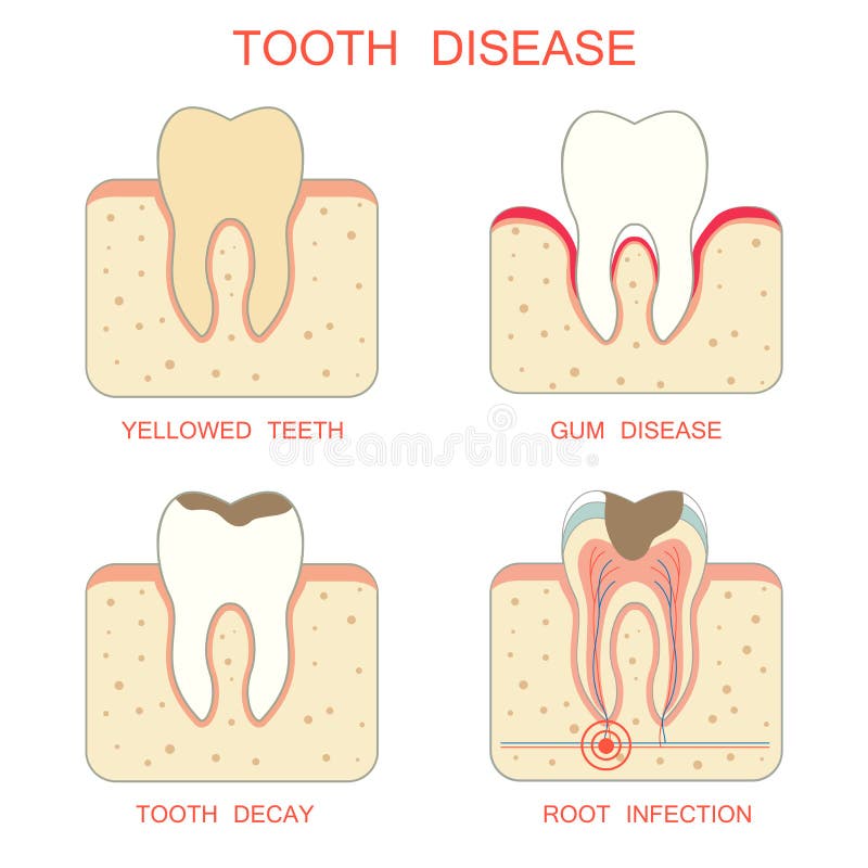 Tooth disease stock vector. Illustration of periodontitis - 53812155