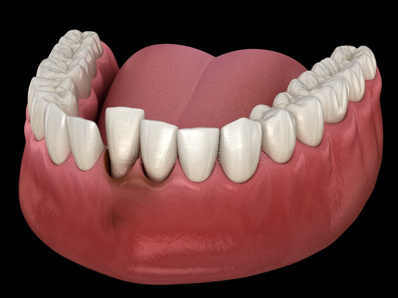 Tooth Dislocation after Trauma. Medically Accurate 3D Illustration ...