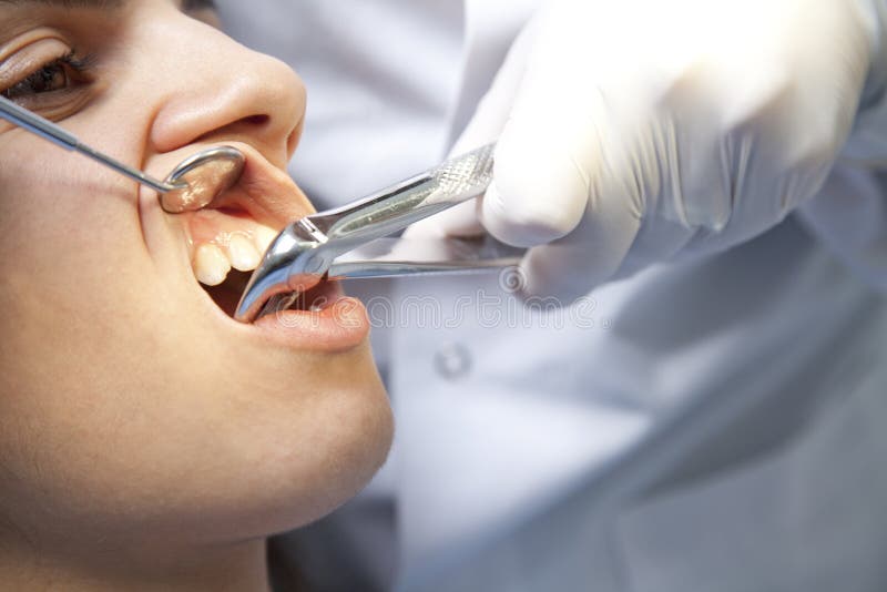 Tooth extraction stock photo. Image of extract, clinic - 21604814