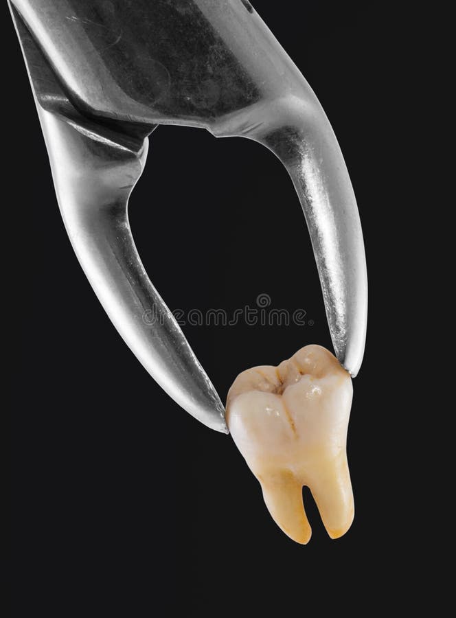Tooth extraction stock photo. Image of office, dentist - 28542320
