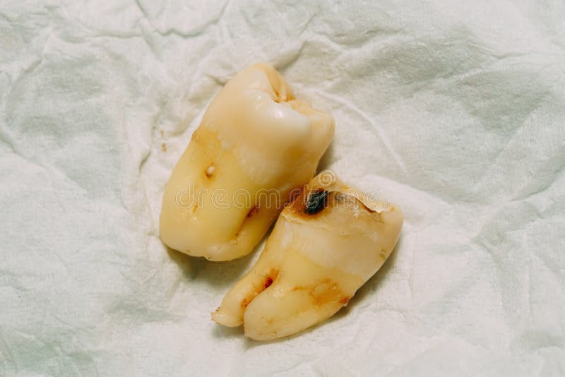 253 Bad Tooth Extraction Stock Photos - Free & Royalty-Free Stock ...