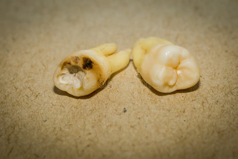 253 Bad Tooth Extraction Stock Photos - Free & Royalty-Free Stock ...