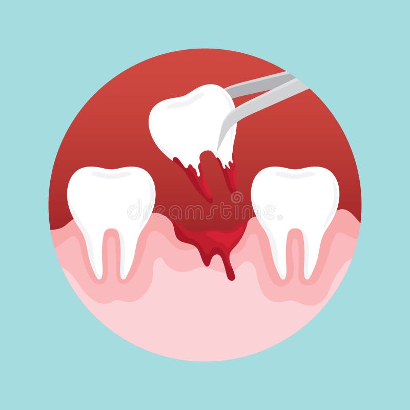 Tooth Extraction Stock Illustrations – 1,326 Tooth Extraction Stock ...
