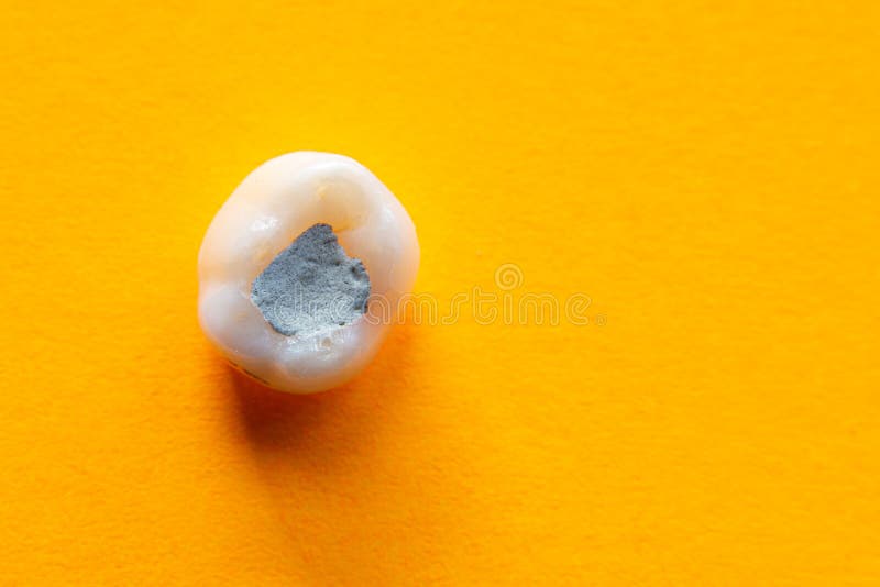 Tooth with a Filling Close-up on a Yellow Background Stock Image ...