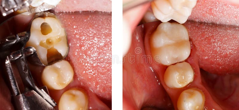 Tooth filling by dentist stock image. Image of collection - 28980833