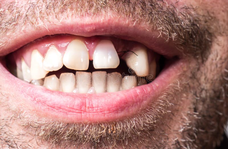 Tooth Gap after a Cyst Surgery Stock Photo - Image of caries, face ...