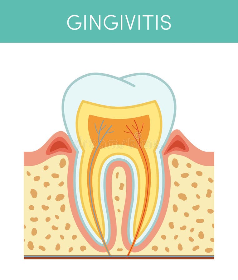 Gingivitis and bleeding stock vector. Illustration of children - 86025286