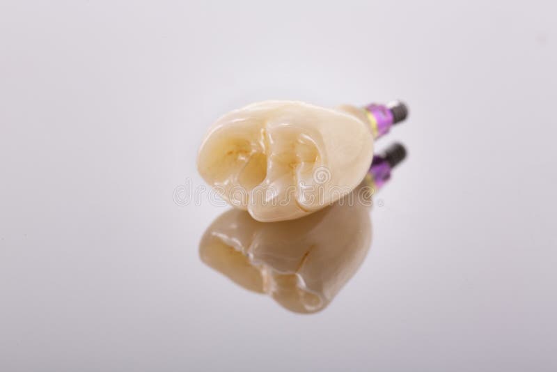Tooth Human Implant. Dental Concept. Ceramic Human Teeth or Dentures ...