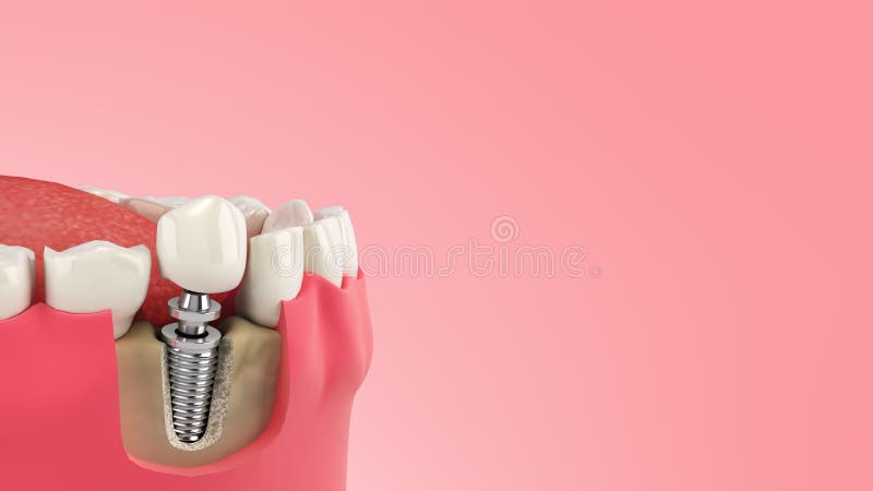 Tooth Human Single Implant Dental Concept Human Teeth or Dentures 3d ...
