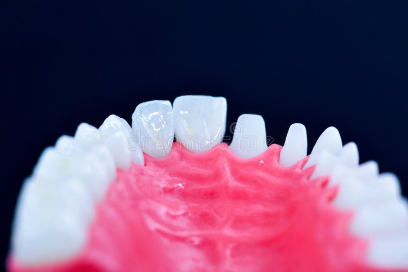 Tooth Implant and Crown Installation Process Stock Photo - Image of ...