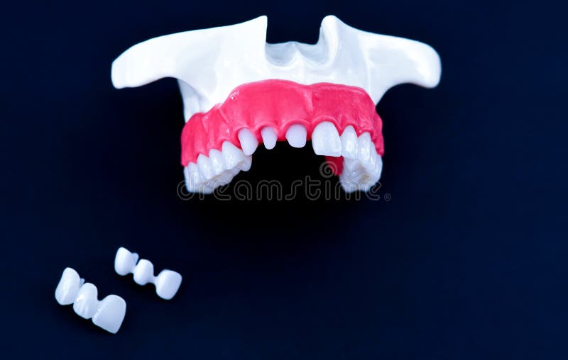 Tooth Implant and Crown Installation Process Stock Photo - Image of ...
