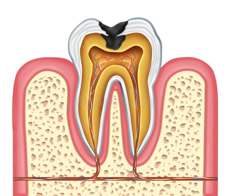 Tooth Inner Anatomy of a Cavity Stock Illustration - Illustration of ...