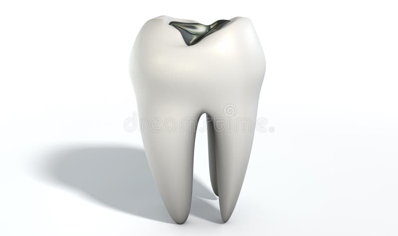 Tooth with Lead Filling stock photo. Image of tooth, flesh - 56018952