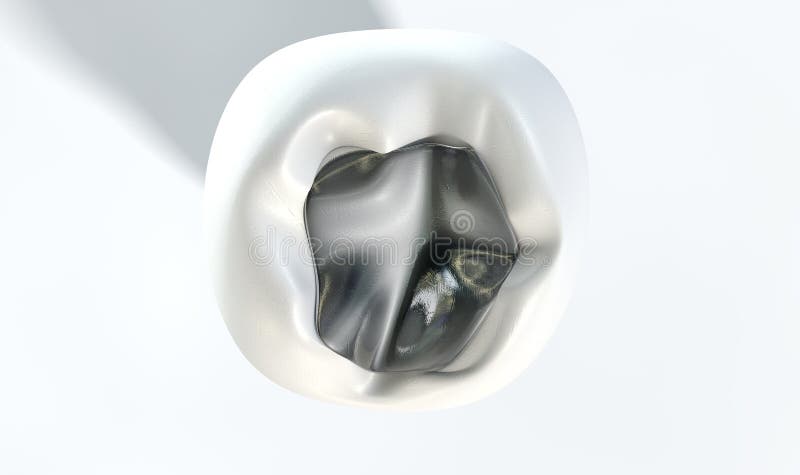 Teeth with Lead Filling stock photo. Image of teeth, tooth - 56018538