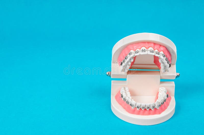 Tooth Model with Metal Wire Dental Braces Stock Image - Image of model ...