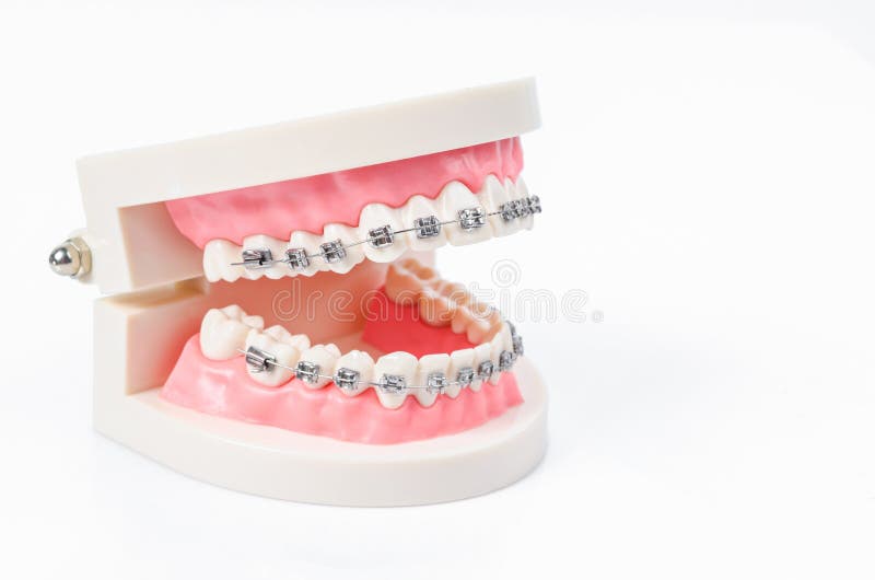 Tooth Model with Metal Wire Dental Braces Stock Image - Image of ...