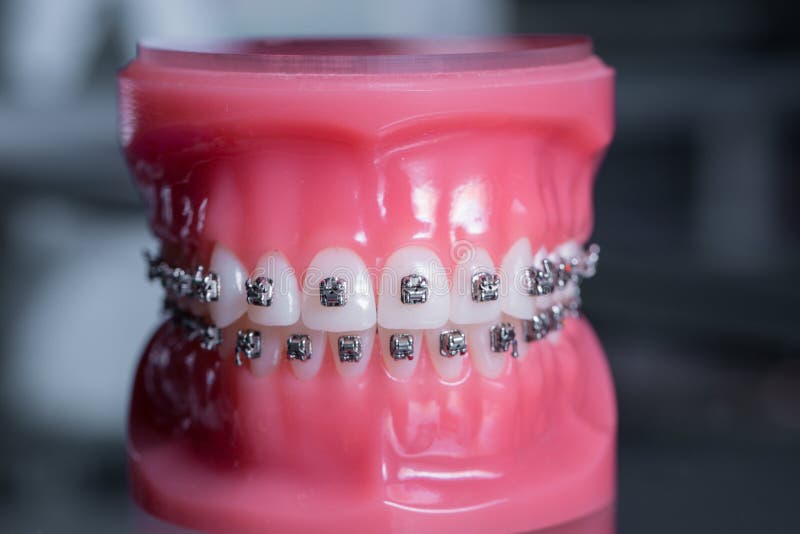Tooth Model with Metal Wire Dental Braces. Stock Photo - Image of ...