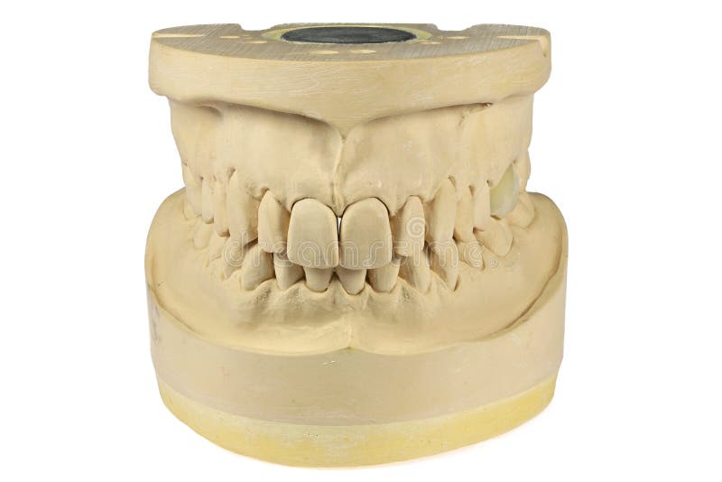 Tooth model stock image. Image of dental, custom, restoration - 205729713