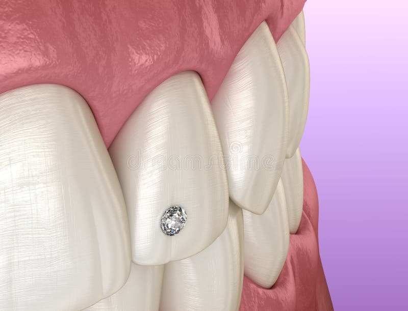 Tooth Piercing by Diamond, 3D Illustration Concept Stock Illustration ...