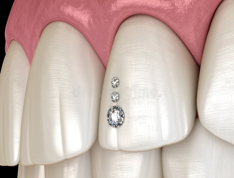 Tooth Piercing by Diamond, 3D Illustration Concept Stock Illustration ...