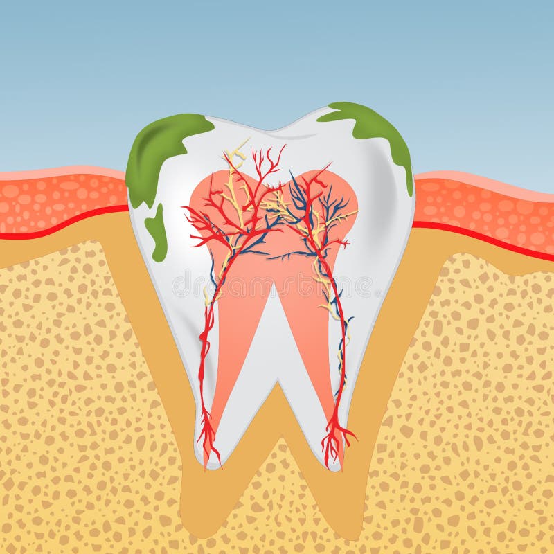 Tooth with abscess stock illustration. Illustration of oral - 129977447