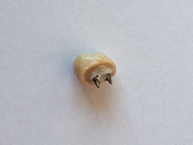 Tooth with post and crown stock photo. Image of failed - 228237850