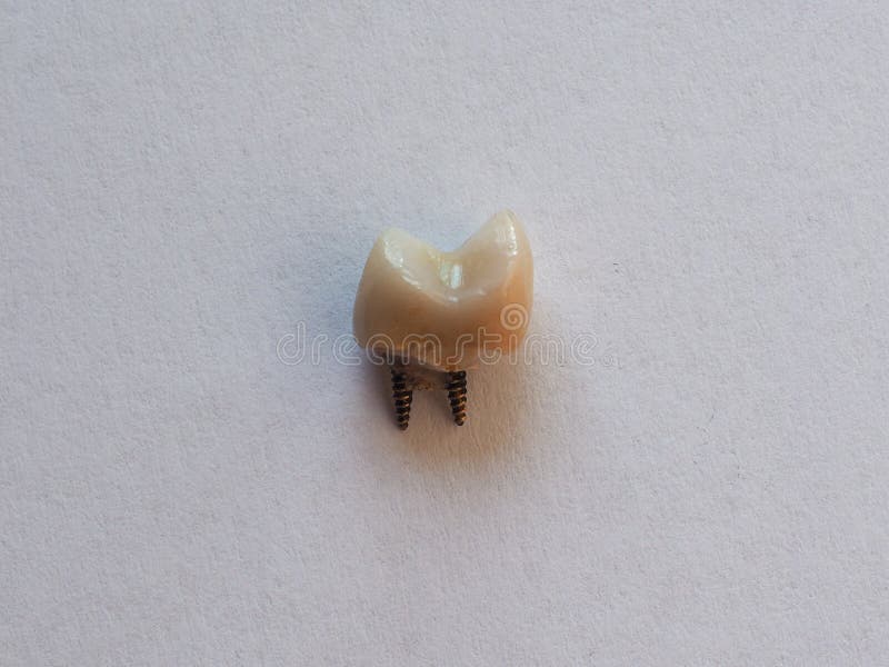 Tooth with post and crown stock image. Image of root - 229836015