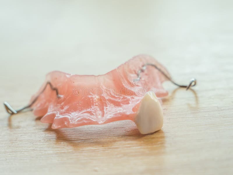 Tooth Prosthesis with One Tooth Stock Image - Image of partial, dental ...