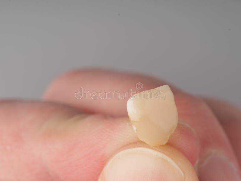 A Tooth Pulled Out in His Hand. Closeup Stock Image - Image of hand ...