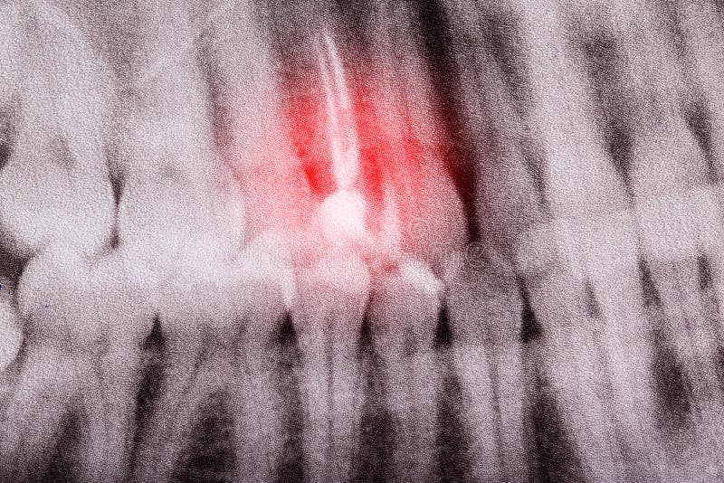 Tooth Pulpitis on a Dental X-ray, Macro. Inflammation of the Root ...