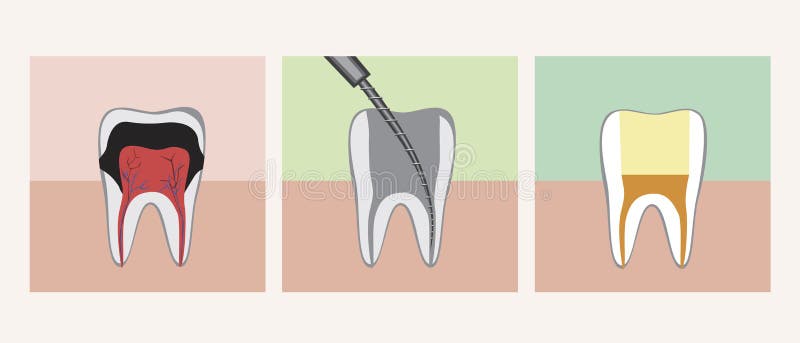 Tooth Pulpitis Treatment Process, Flat Vector Stock Illustration ...