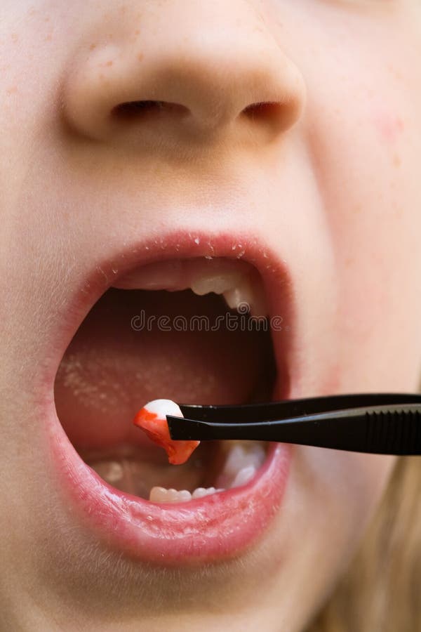 Tooth removal stock image. Image of dentist, mouth, tooth - 5052505