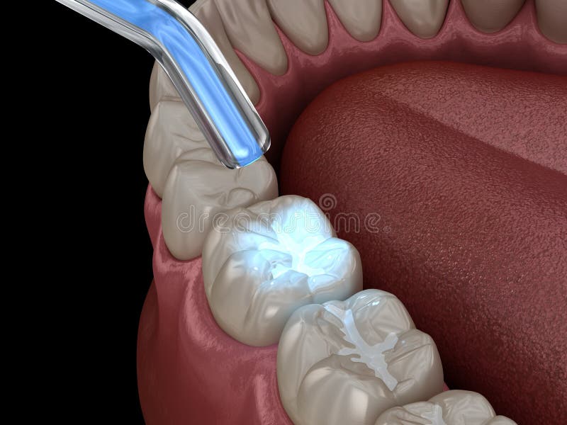 Tooth Restoration with Filling and Polymerization Lamp. Medically ...
