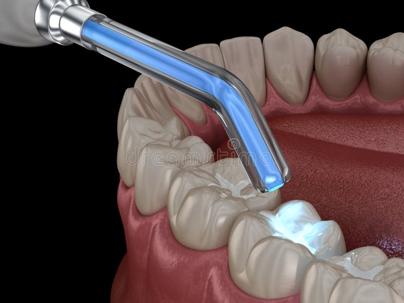 Tooth Restoration with Filling and Polymerization Lamp. Medically ...