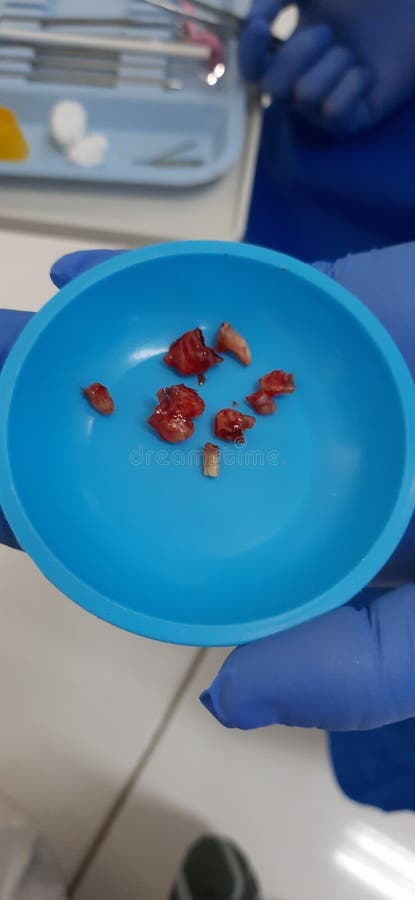 Tooth Roots Removal by Dentist Stock Photo - Image of blood, dentist ...