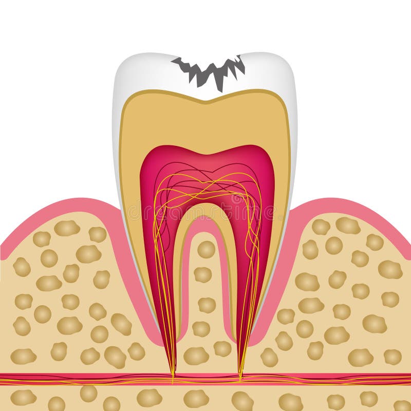 Tooth Structure in Cross Section with Caries To Use on Posters, Stock ...
