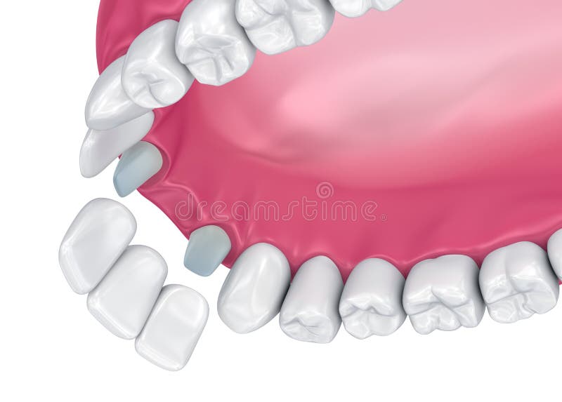 Tooth Supported Fixed Bridge. Medically Accurate Stock Illustration ...