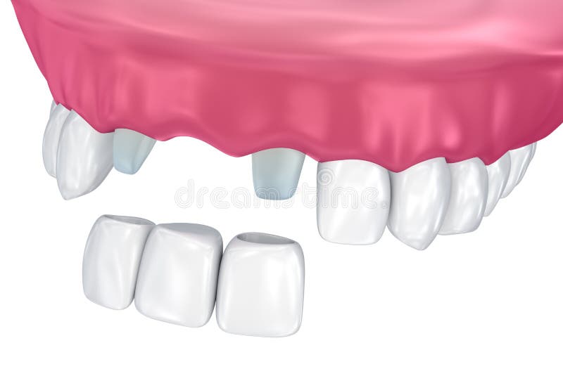 Tooth Supported Fixed Bridge. Medically Accurate Stock Illustration ...