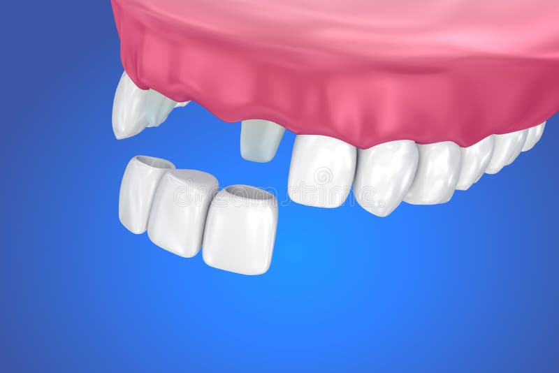 Tooth Supported Fixed Bridge. Medically Accurate Illustration Stock ...