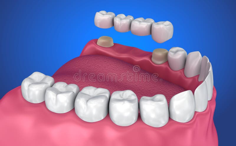Tooth Supported Fixed Bridge. Medically Accurate Illustration Stock ...