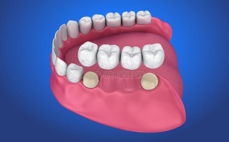Tooth Supported Fixed Bridge. Medically Accurate Illustration Stock ...