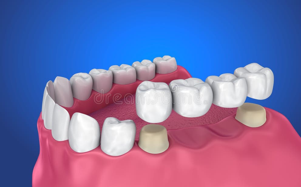 Tooth Supported Fixed Bridge. Medically Accurate Illustration Stock ...