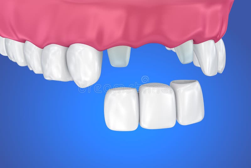 Tooth Supported Fixed Bridge. Medically Accurate 3D Illustration Stock ...