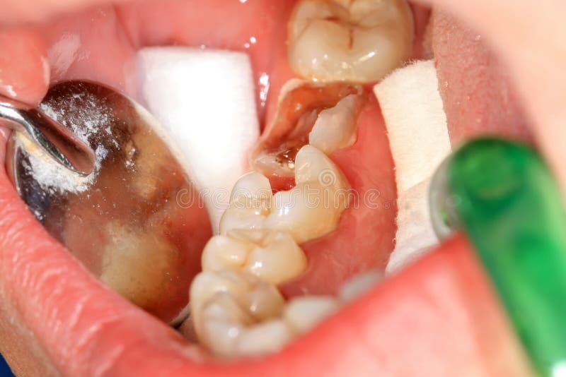 Tooth treatment stock photo. Image of clinic, health - 28683386