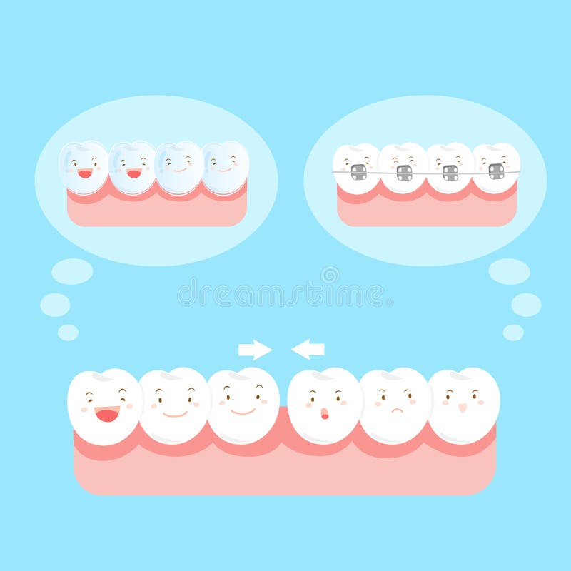 Tooth wear different brace stock vector. Illustration of comic - 96061835