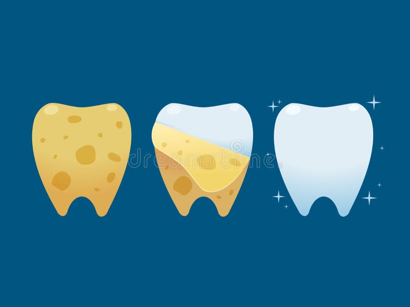 The Tooth Whitening Phase. Isolated Vector Illustration Stock ...