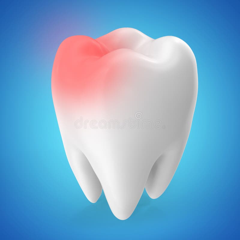 Toothache Concept, Caries Concept Isolated on Blue Tints. 3D Rendering ...