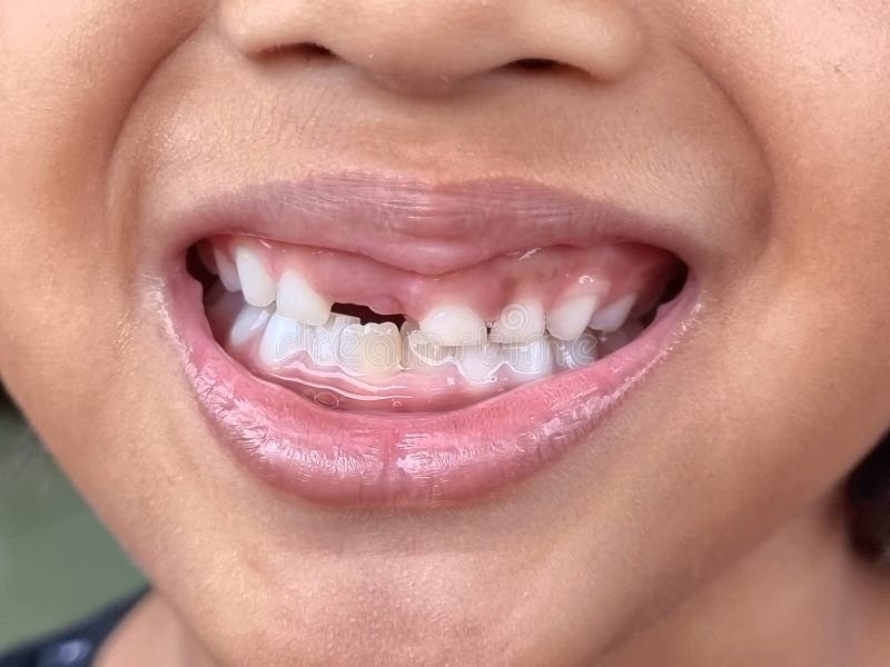 Toothless Asian Girl Smiling Happily Stock Photo - Image of dental ...