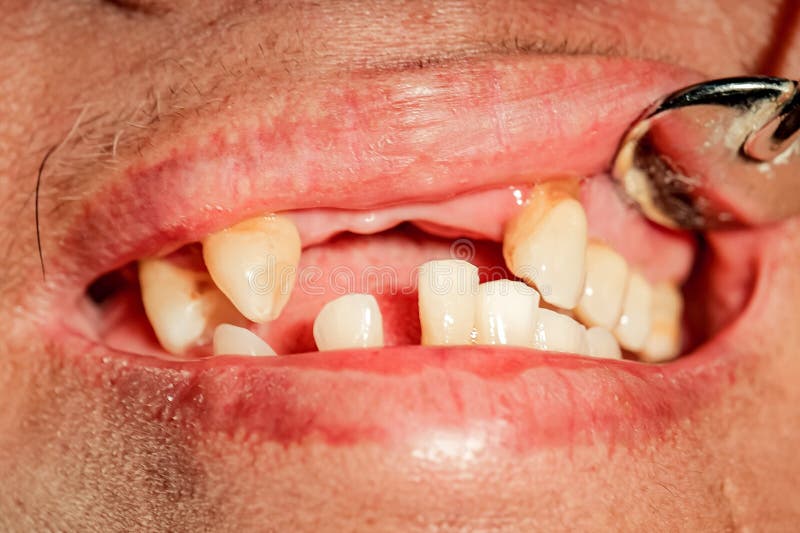 The Toothless Condition of a Patient. Stock Image - Image of hygiene ...
