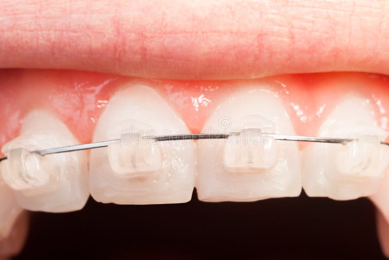 Top Tooth Alignment with Ceramic Braces Stock Photo - Image of open ...